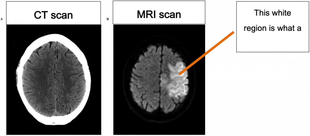 Stroke-IMPaCT | Issue 3: A Delve into MRI